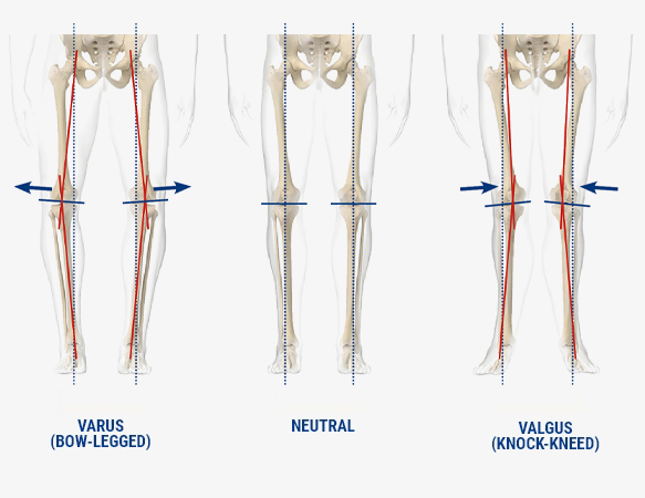 Knee replacement alignment techniques | Medacta